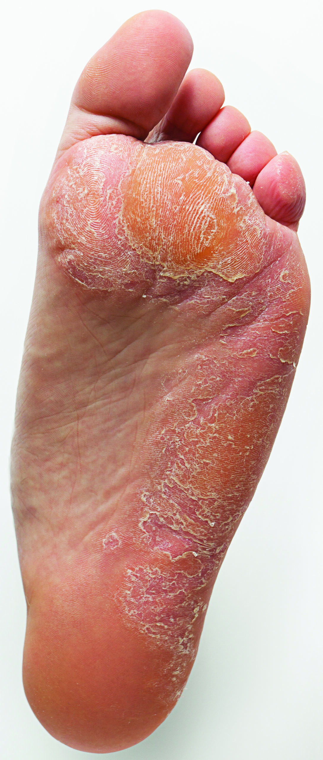 Give Foot Pain the Boot | Bottom Line Inc